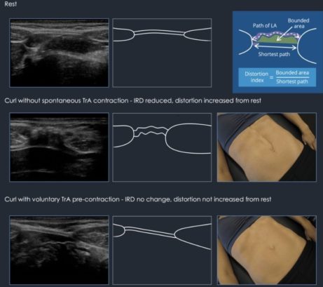 Jaký je rozdíl mezi diastázou a rozestupem? | Fit and Tasty